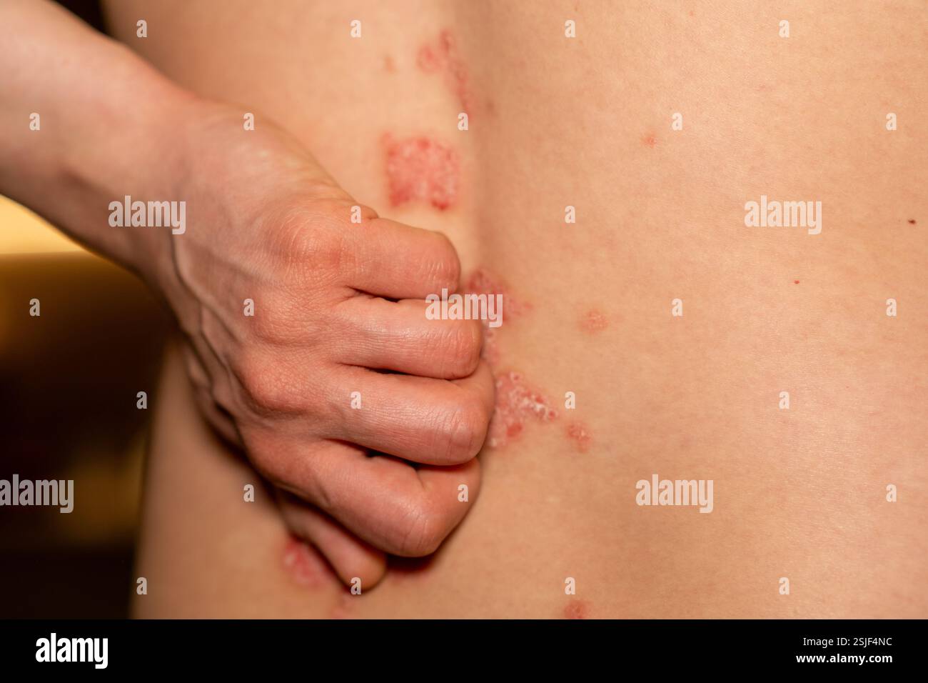 Symptoms of psoriasis visible on skin with red, itchy patches affecting ...