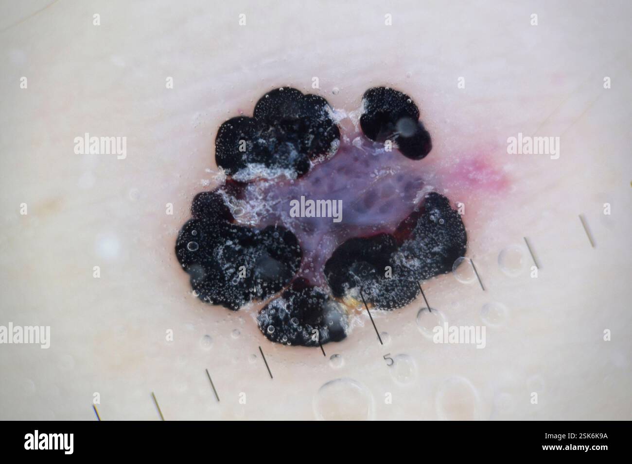 Thrombosed (clotted) angioma on the skin of a 55 year old female ...