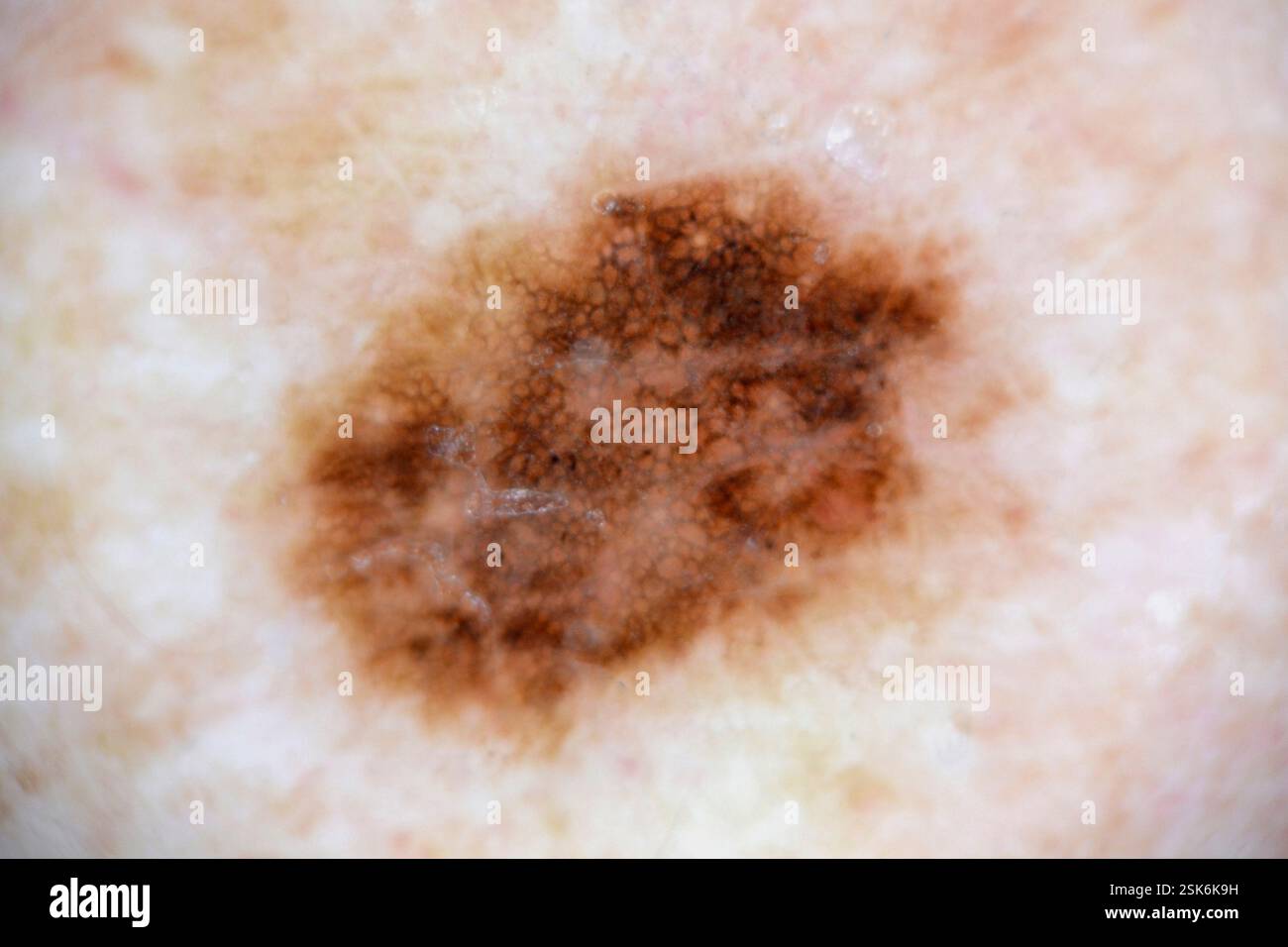 Malignant melanoma on the skin of a 74 year old male patient. Melanoma is a type of skin cancer ...