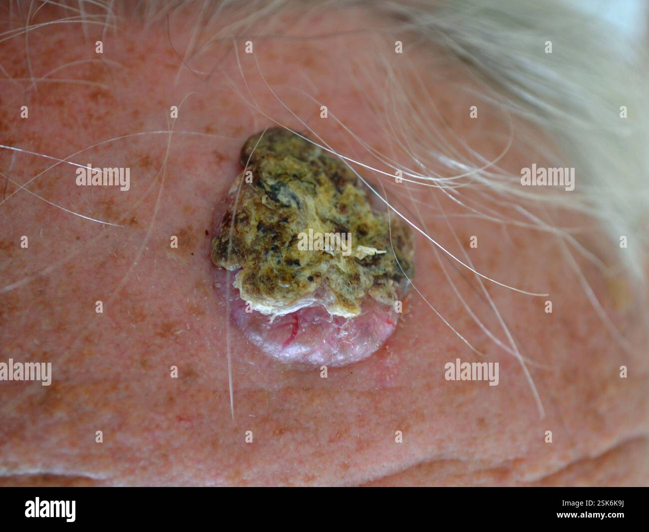 Lymph node cancer, light micrograph Stock Photo - Alamy