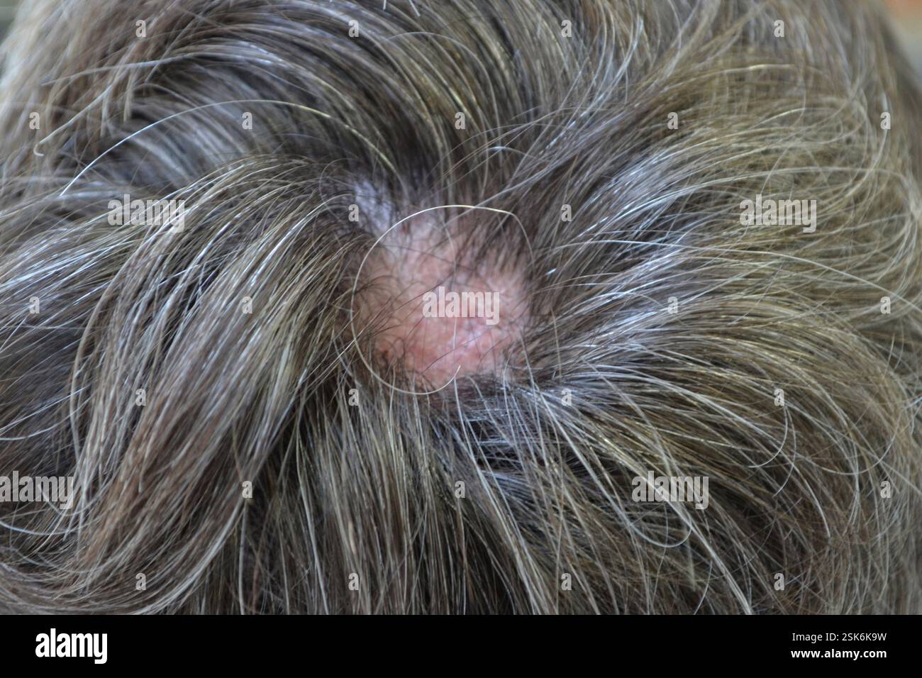 Lymph node cancer, light micrograph Stock Photo - Alamy