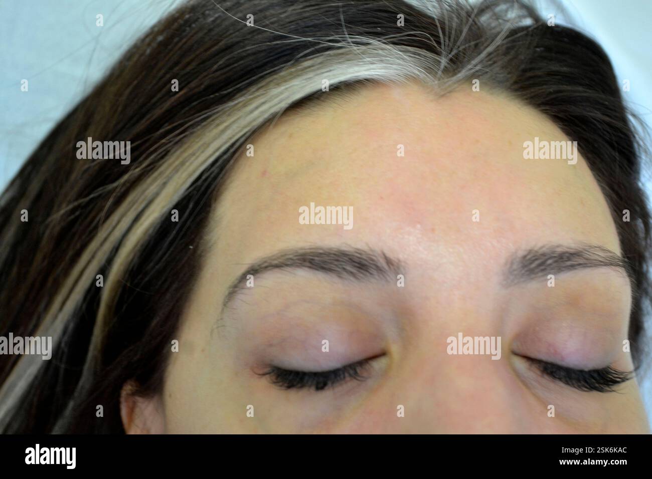 White streak in the hair of a 32 year old female patient with ...