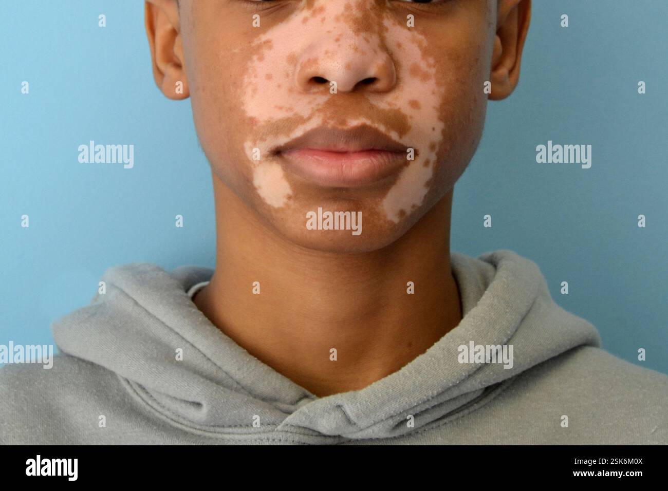 Secondary bone cancer, gamma scan Stock Photo - Alamy