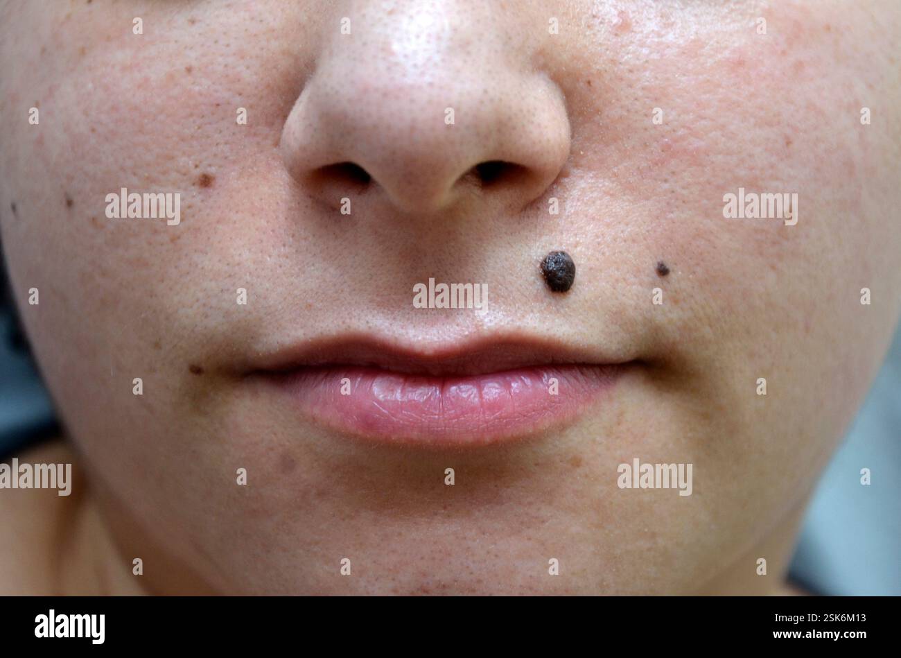 Naevocellular naevus on the upper lip of a 26 year old female patient ...
