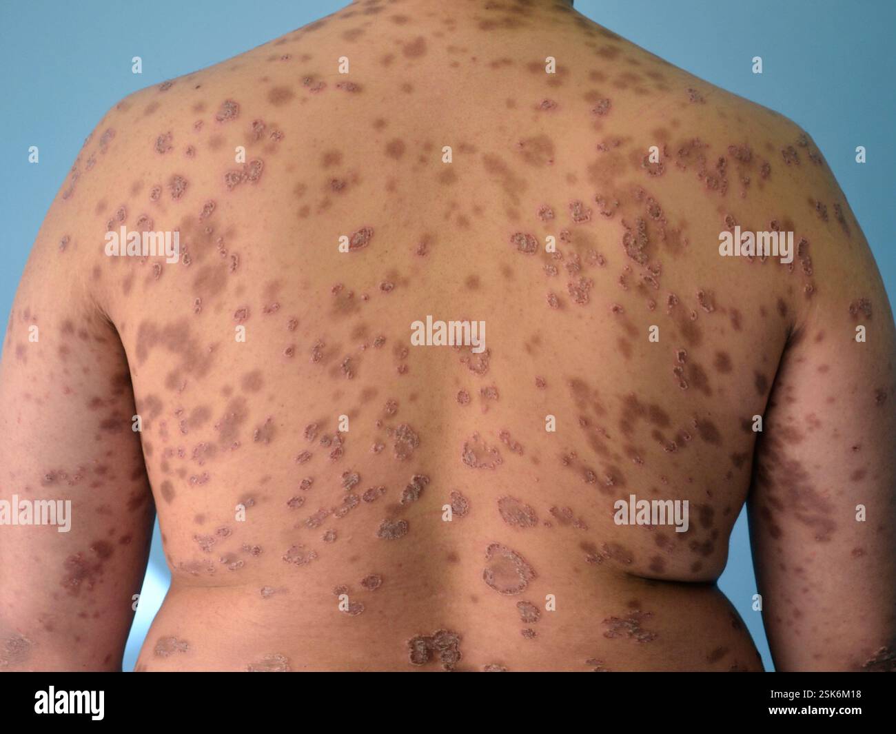 Lesions on the back of a 22 year old male patient with prurigo. Prurigo ...
