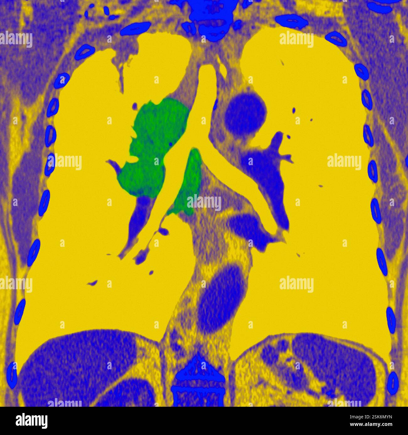 Lung cancer. Coloured computed tomography (CT) scan of a section through the chest of a male ...
