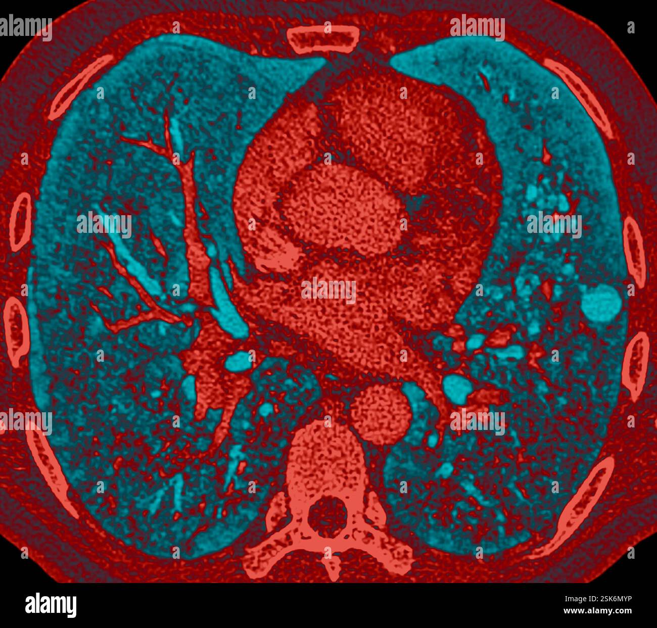 Pneumocystis pneumonia. Coloured computed tomography (CT) scan of an ...