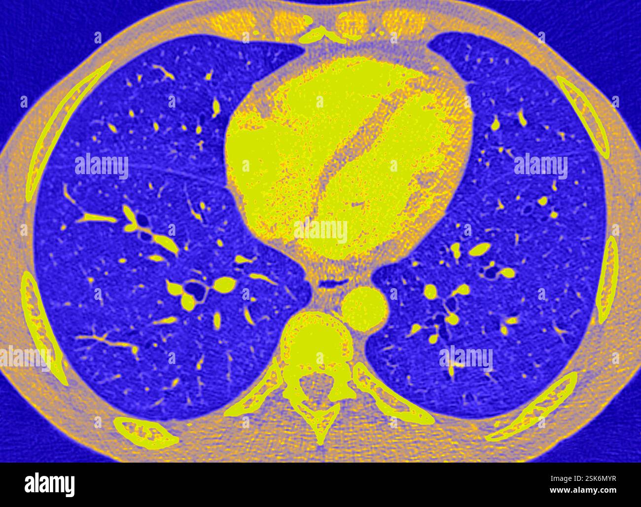 Normal heart and lungs. Coloured computed tomography (CT) scan of an axial section through a ...