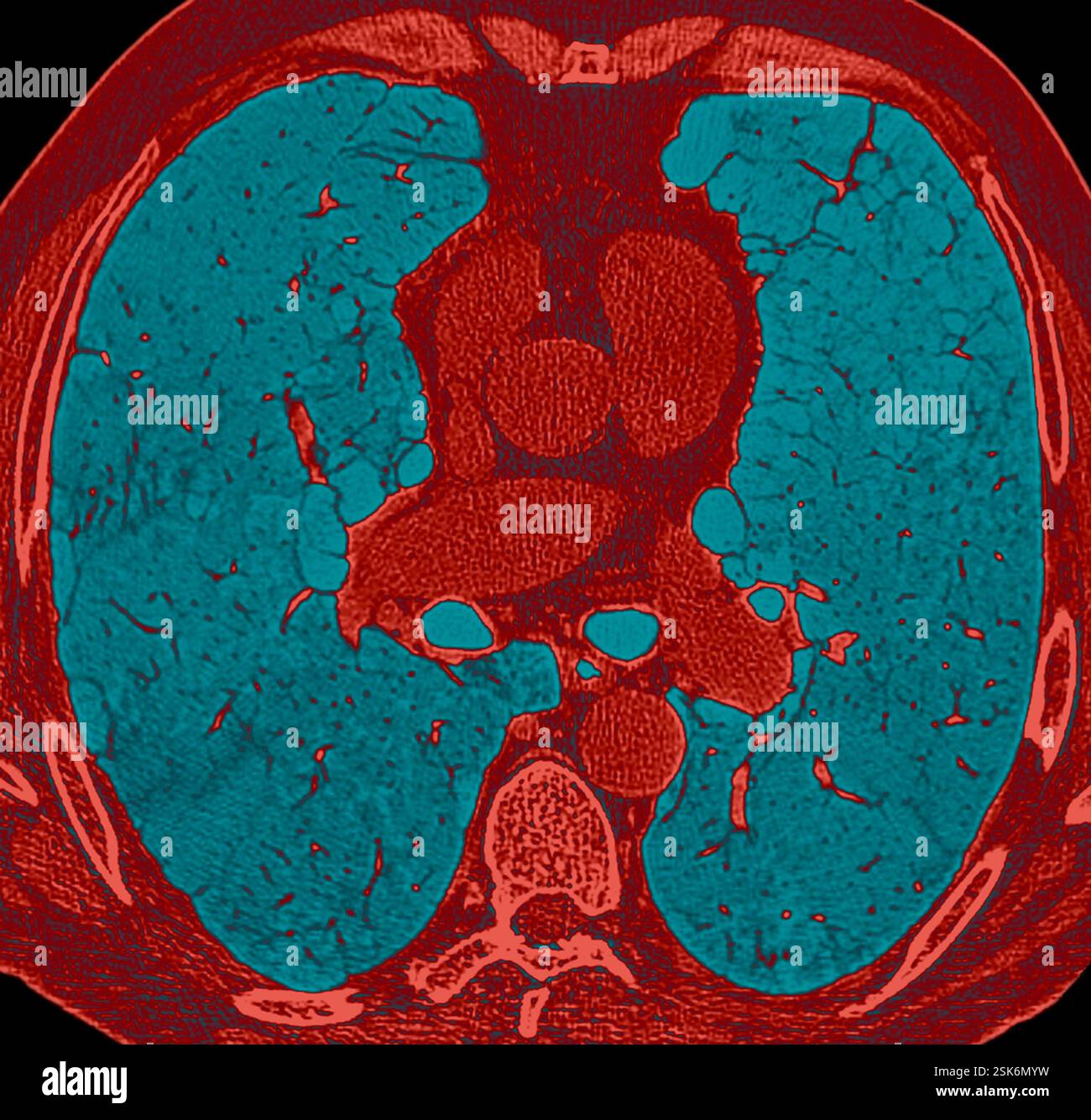 Emphysema. Coloured computed tomography (CT) scan of an axial section ...