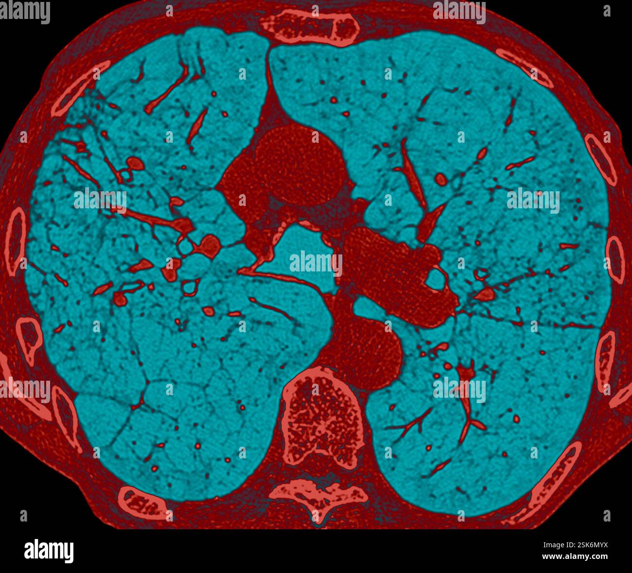 Emphysema. Coloured computed tomography (CT) scan of an axial section ...