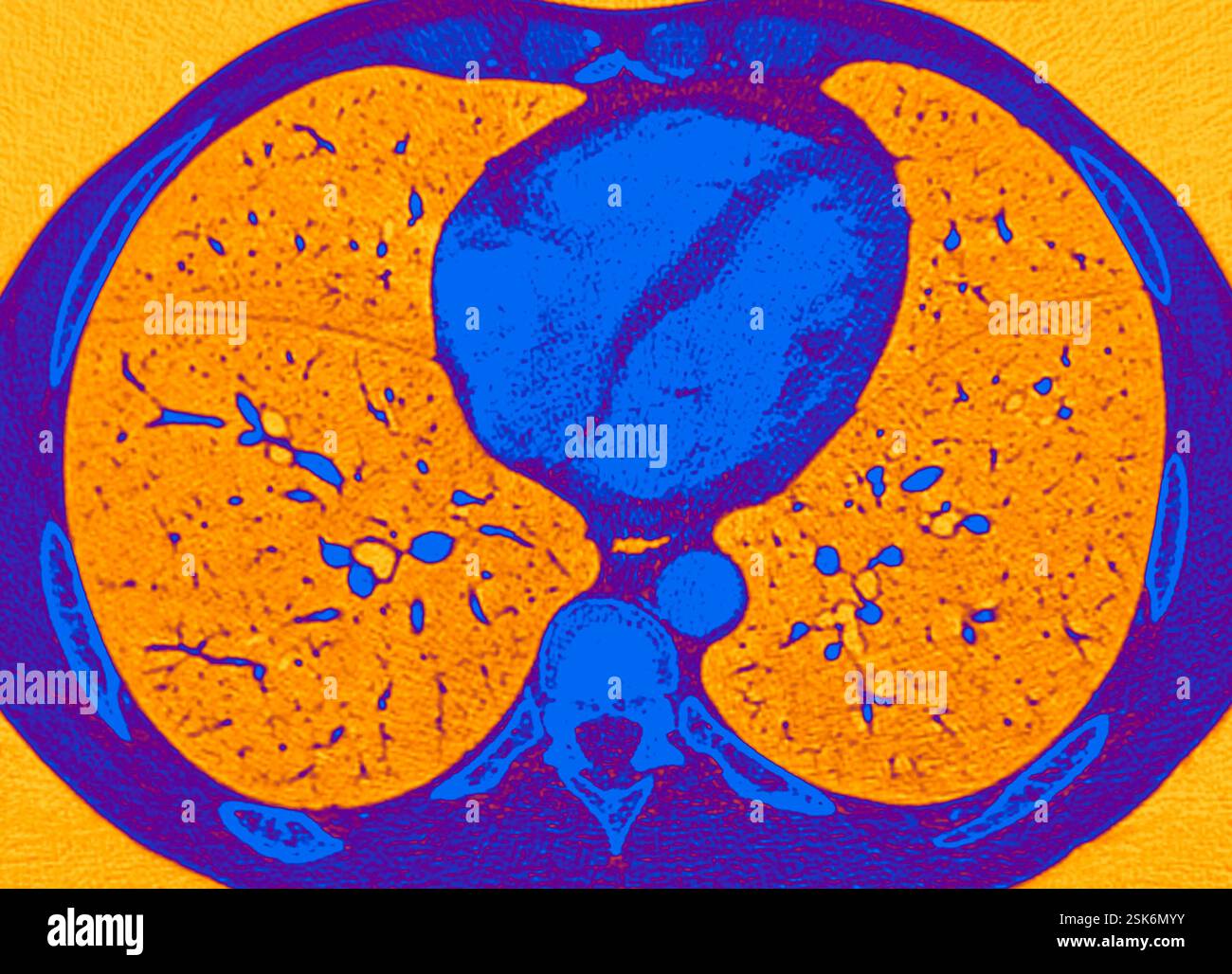 Normal heart and lungs. Coloured computed tomography (CT) scan of an axial section through a ...