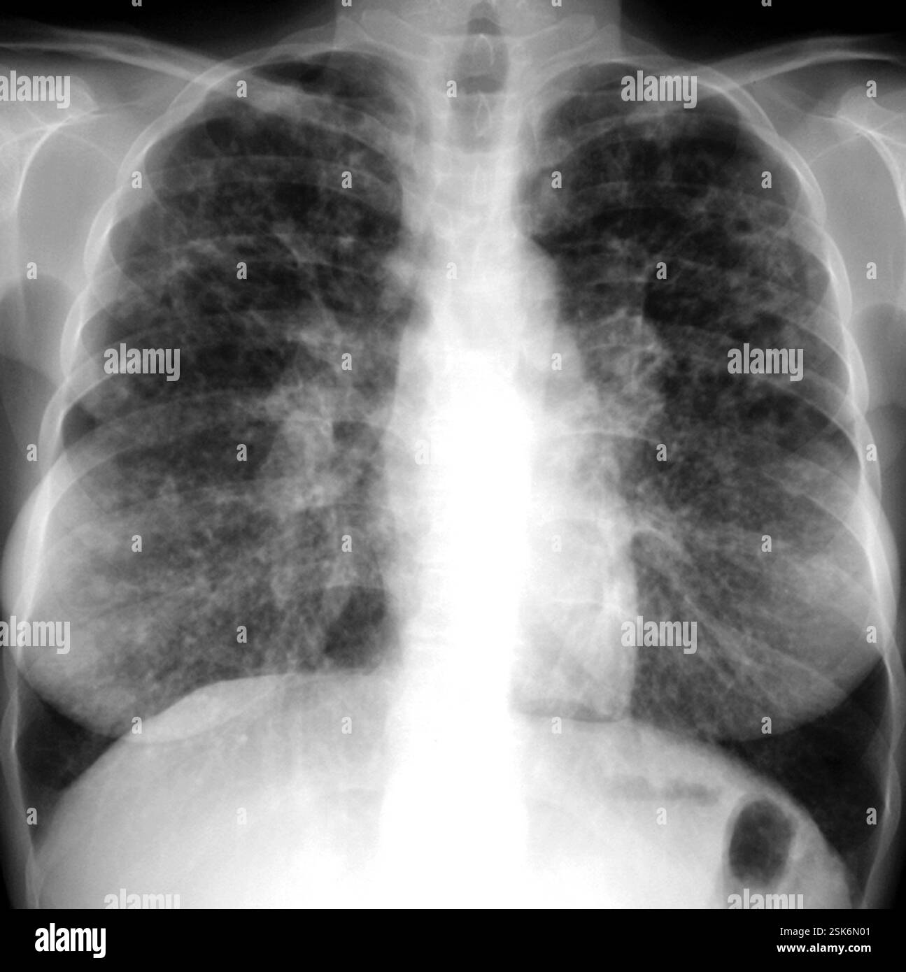 Cystic fibrosis. Frontal chest X-ray of a female patient with cystic ...