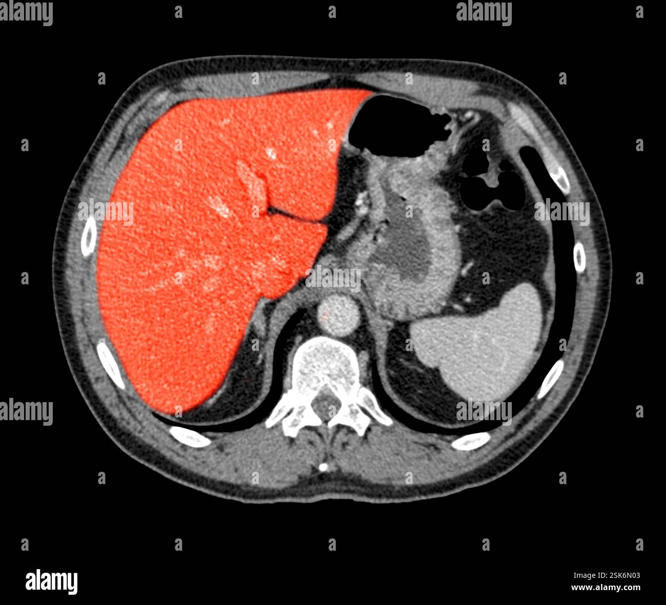 Normal liver and spleen. Coloured computed tomography (CT) scan of an axial section through a ...