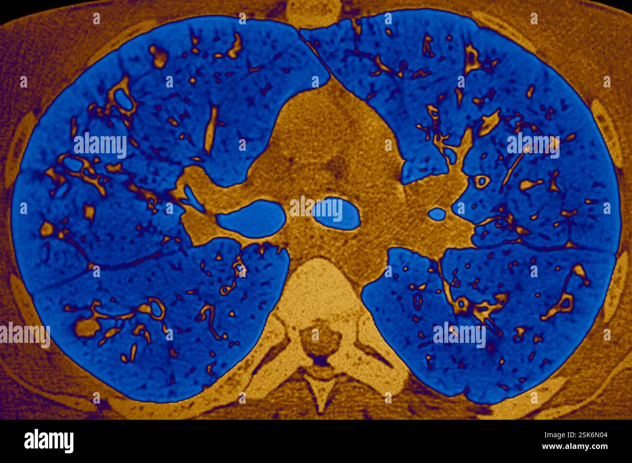 Cystic fibrosis. Coloured computed tomography (CT) scan of an axial ...