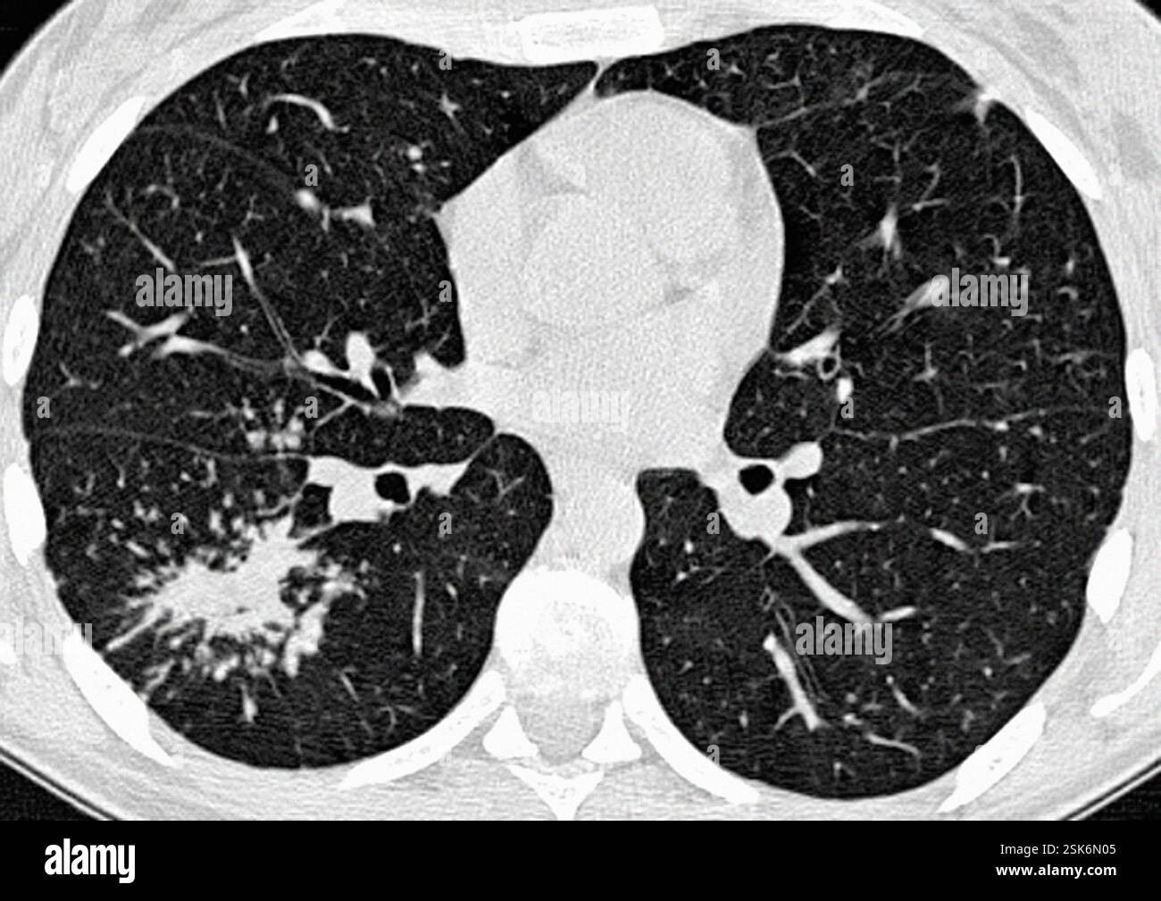 Pulmonary sarcoidosis. Computed tomography (CT) scan of an axial ...