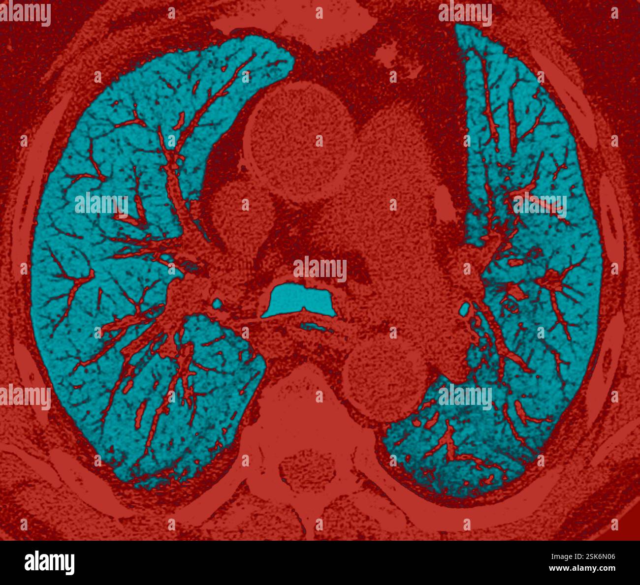 Pulmonary siderosis. Coloured computed tomography (CT) scan of an axial ...