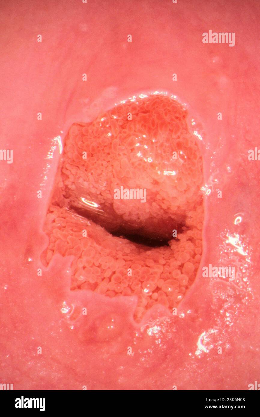 Normal cervix. Endoscopic view of the healthy cervix of a woman. The ...
