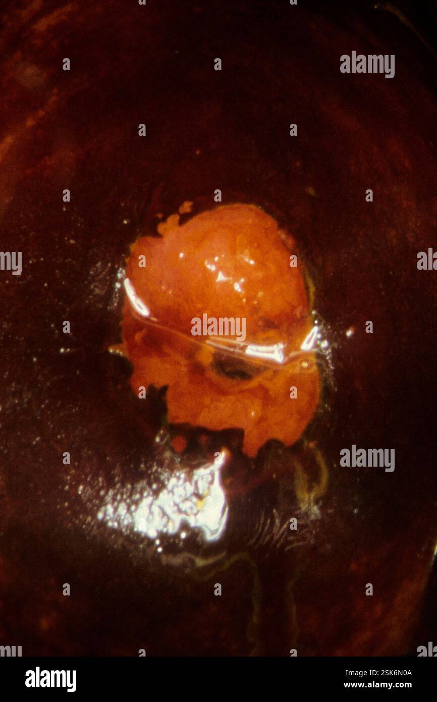 Normal cervix. Endoscopic view of the healthy cervix of a woman. The ...