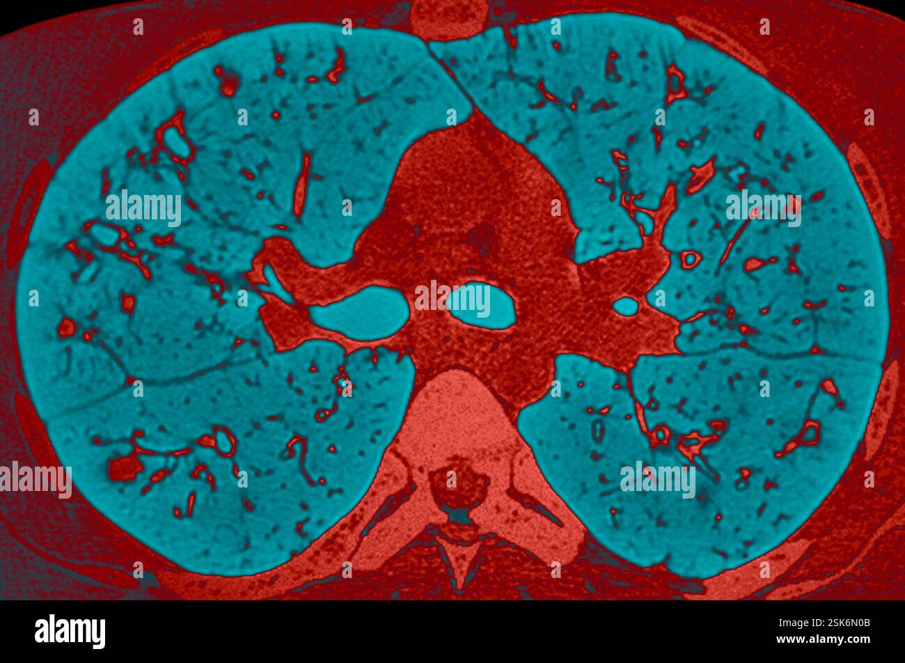 Cystic fibrosis. Coloured computed tomography (CT) scan of an axial ...