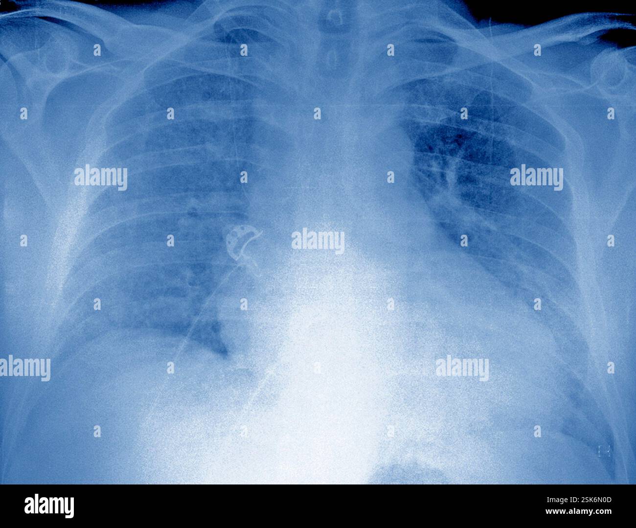 Pneumocystis pneumonia. Frontal chest X-ray of a male patient with ...
