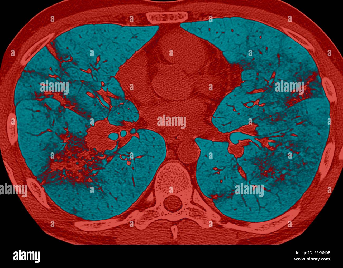 Berylliosis Coloured Computed Tomography Ct Scan Of An Axial Section
