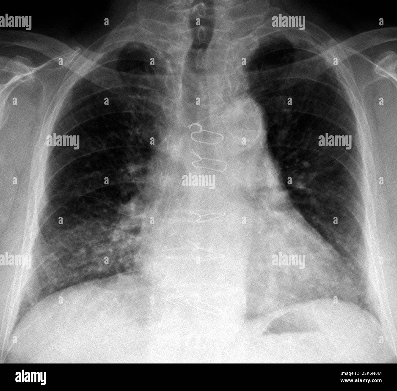 Pulmonary siderosis. Frontal chest X-ray of a male patient with ...
