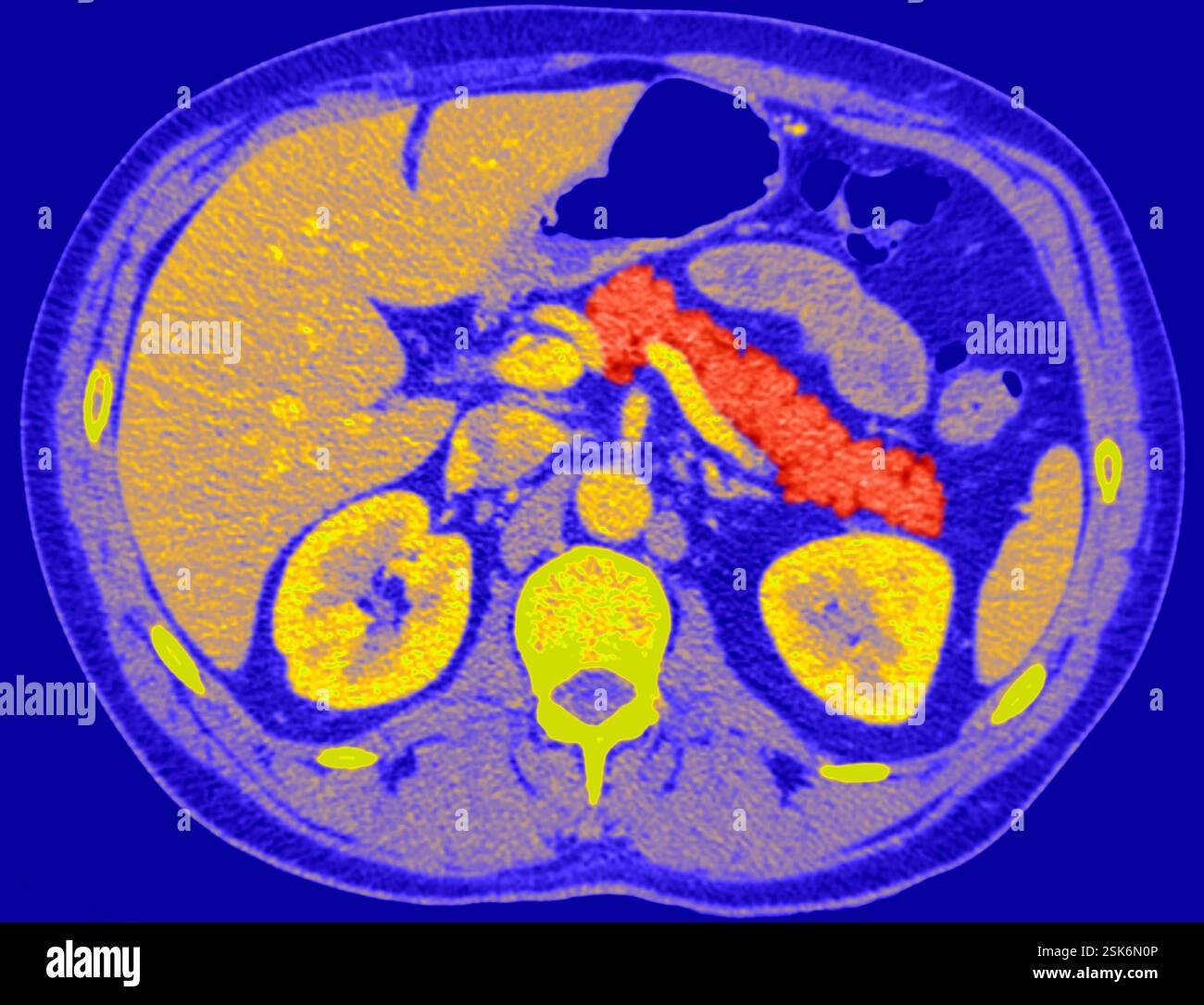 Normal abdominal organs. Coloured computed tomography (CT) scan of an axial section through a ...