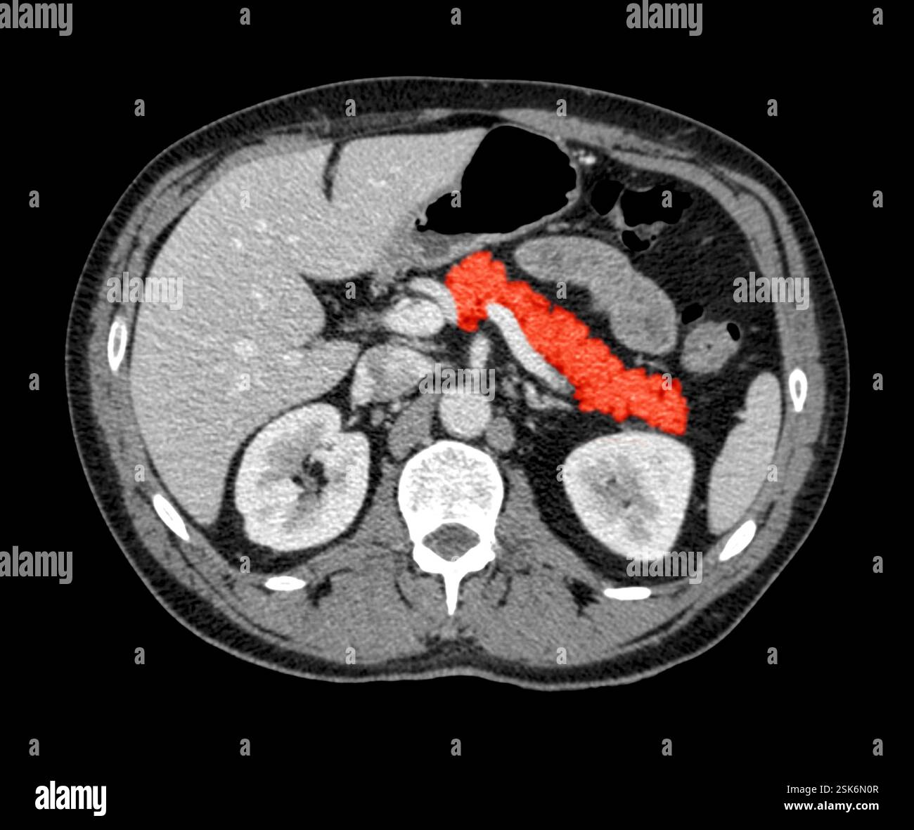 Normal abdominal organs. Coloured computed tomography (CT) scan of an axial section through a ...