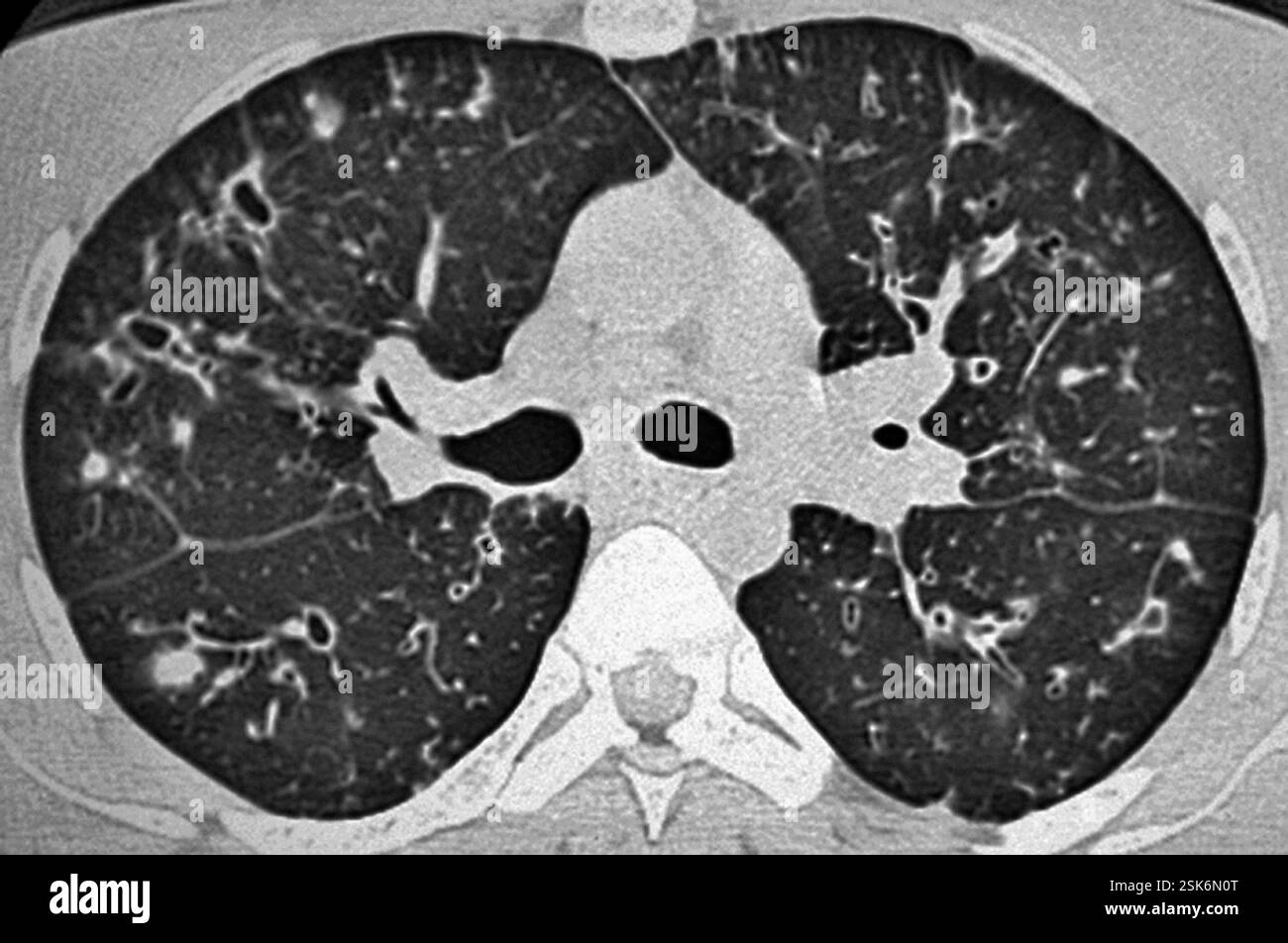 Cystic fibrosis. Computed tomography (CT) scan of an axial section ...