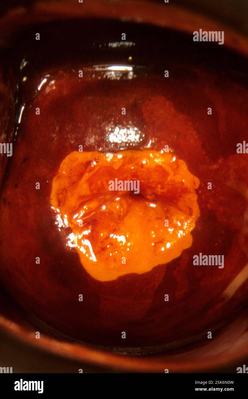 Cervical intraepithelial neoplasia. Iodine stained endoscopic view of ...