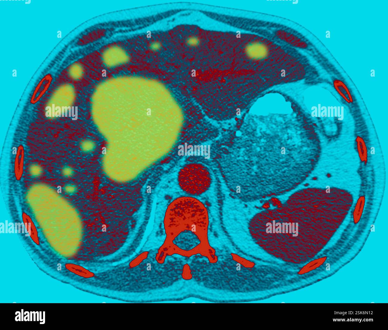 Secondary liver cancer. Coloured computed tomography scan of a section through the abdomen of a ...