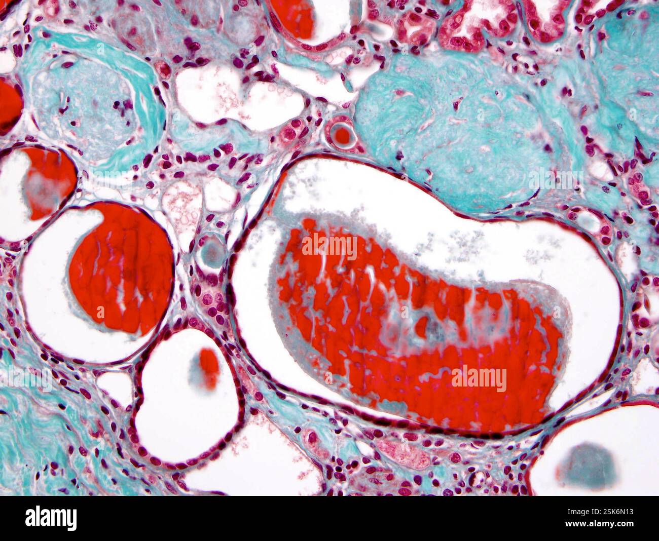 Interstitial nephritis. Light micrograph of a section through a kidney ...