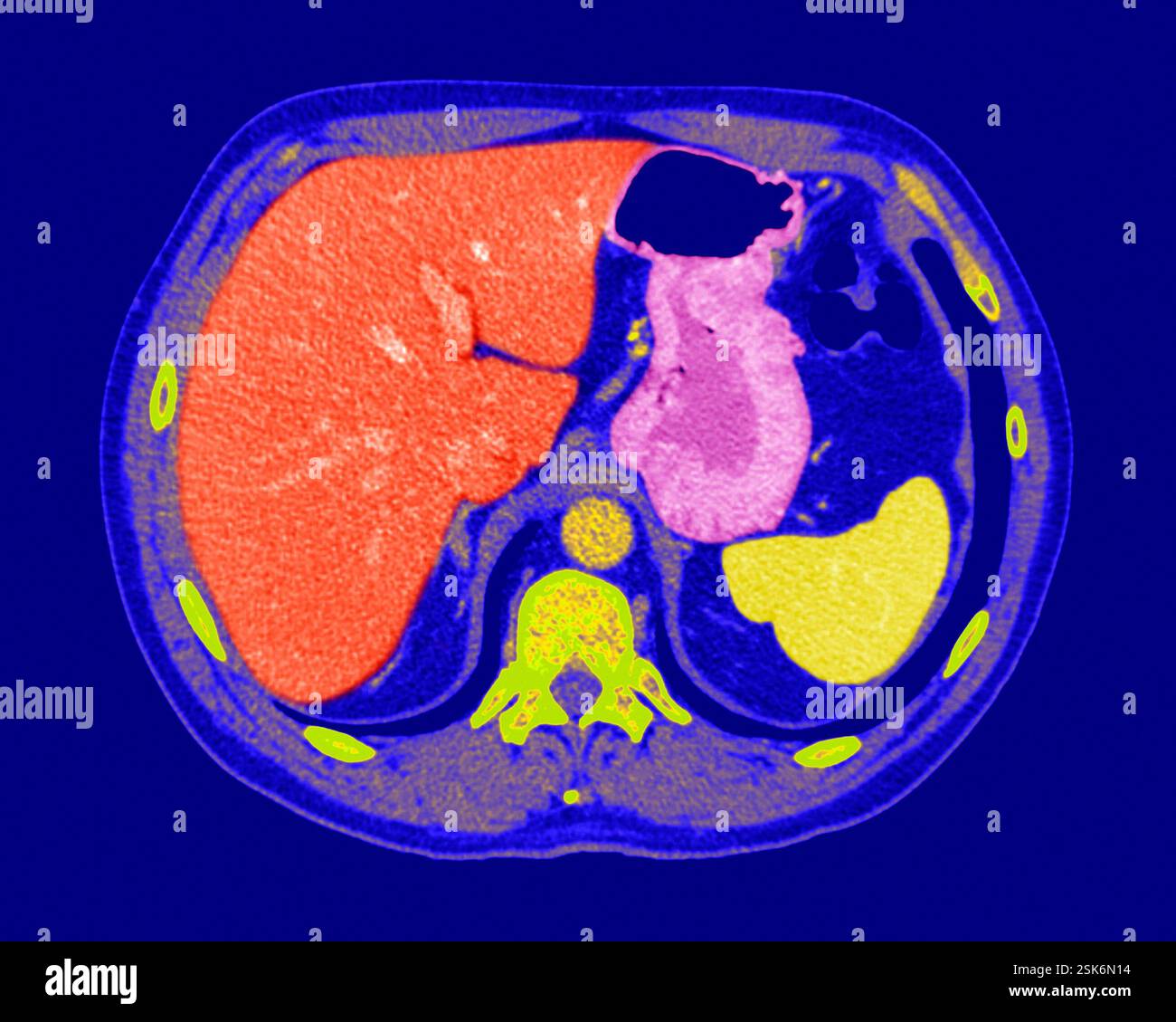 Normal abdominal organs. Coloured computed tomography (CT) scan of an axial section through a ...