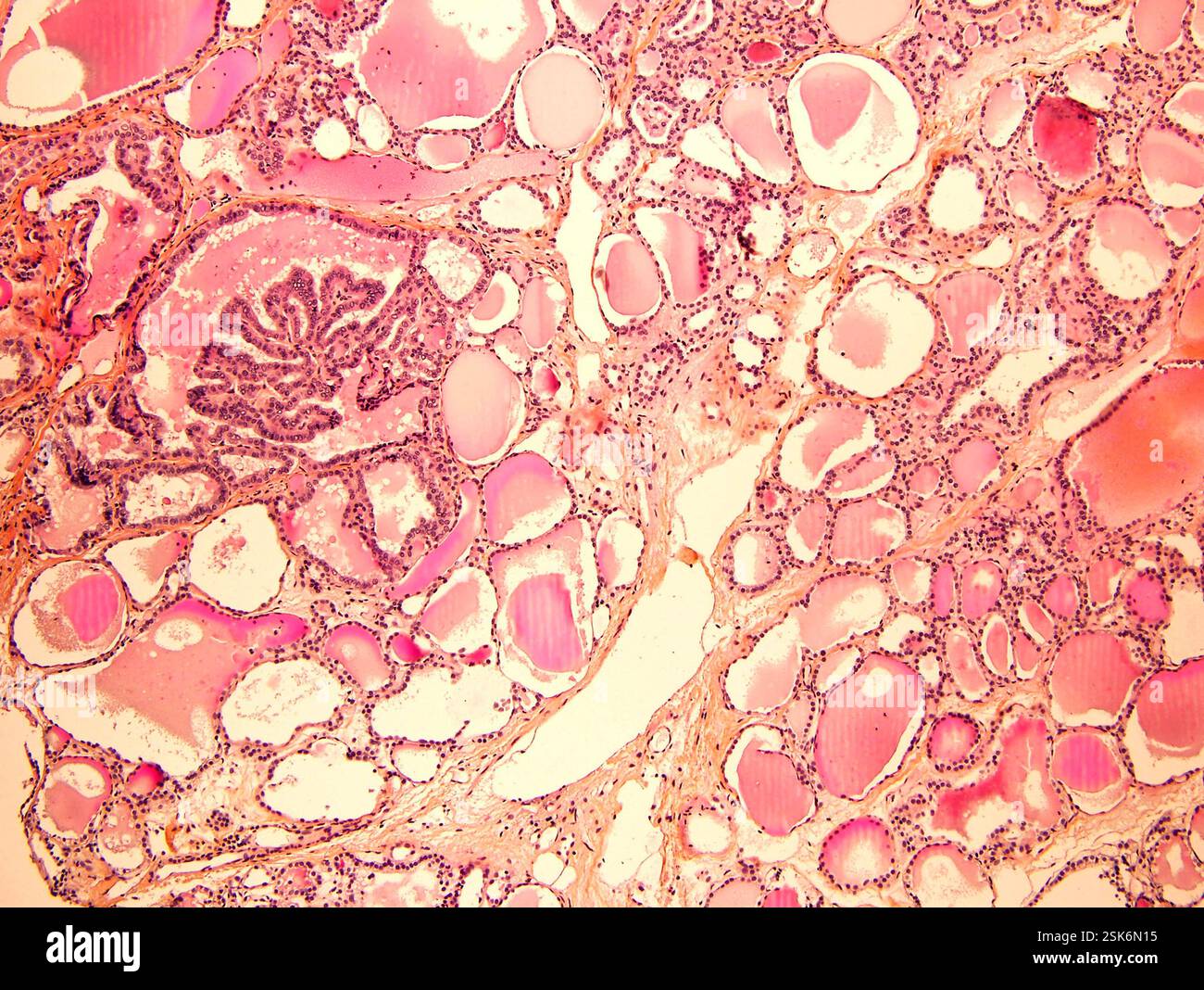 Papillary thyroid cancer. Light micrograph of a section through a small ...