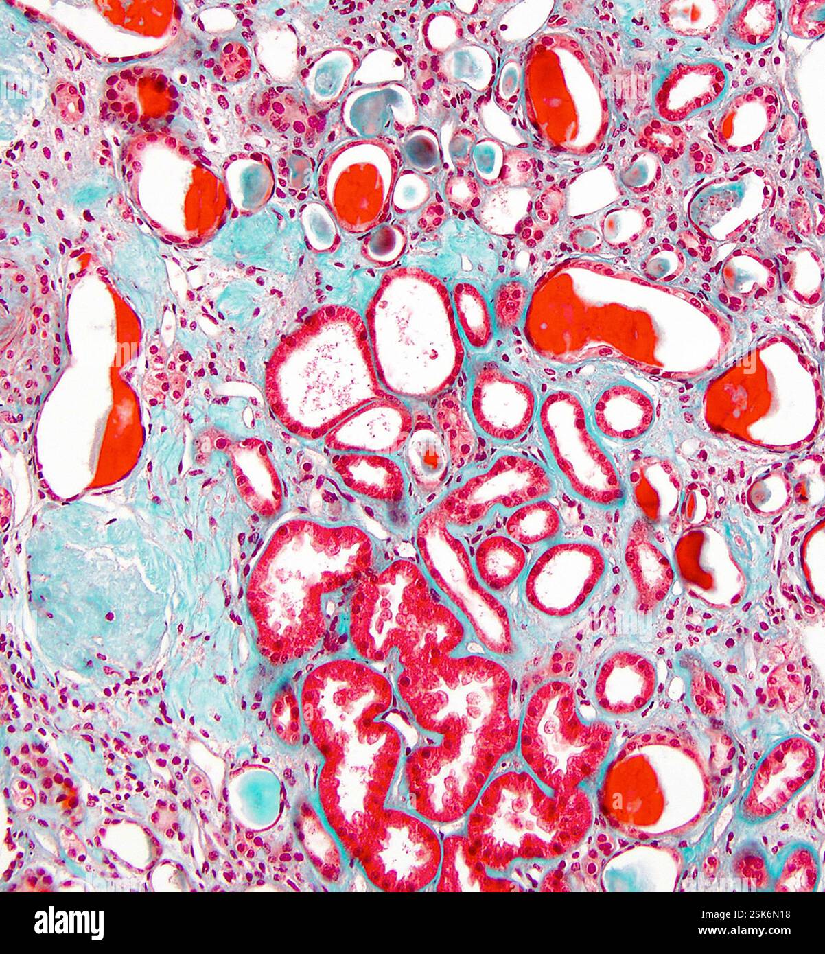 Interstitial nephritis. Light micrograph of a section through a kidney ...