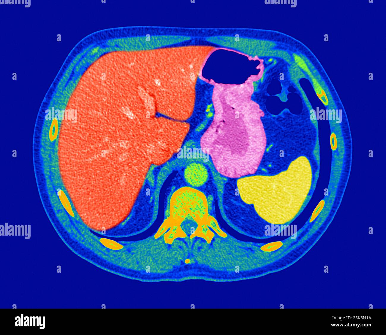 Normal abdominal organs. Coloured computed tomography (CT) scan of an axial section through a ...