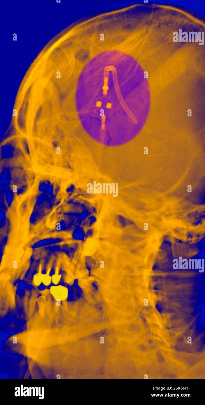 Ventricular shunt. Coloured X-ray showing a ventricular shunt (upper ...