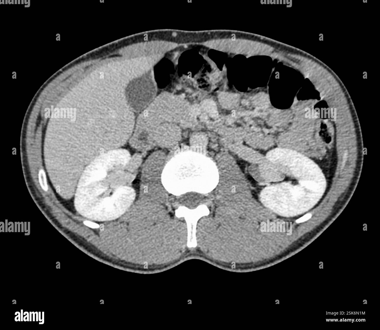 Normal abdominal organs. Computed tomography (CT) scan of an axial ...