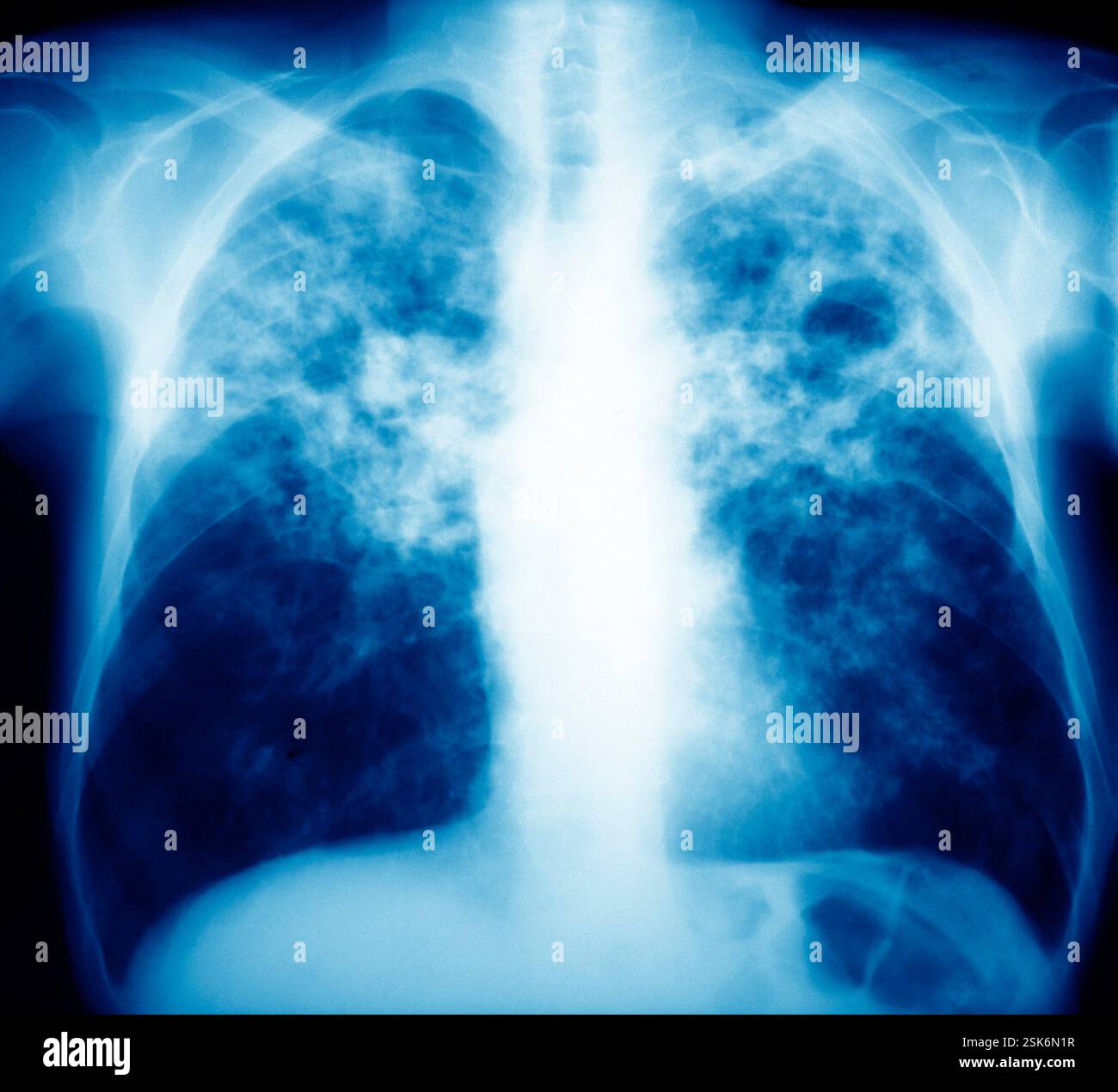Tuberculosis. Coloured frontal chest X-ray of a patient with widespread ...