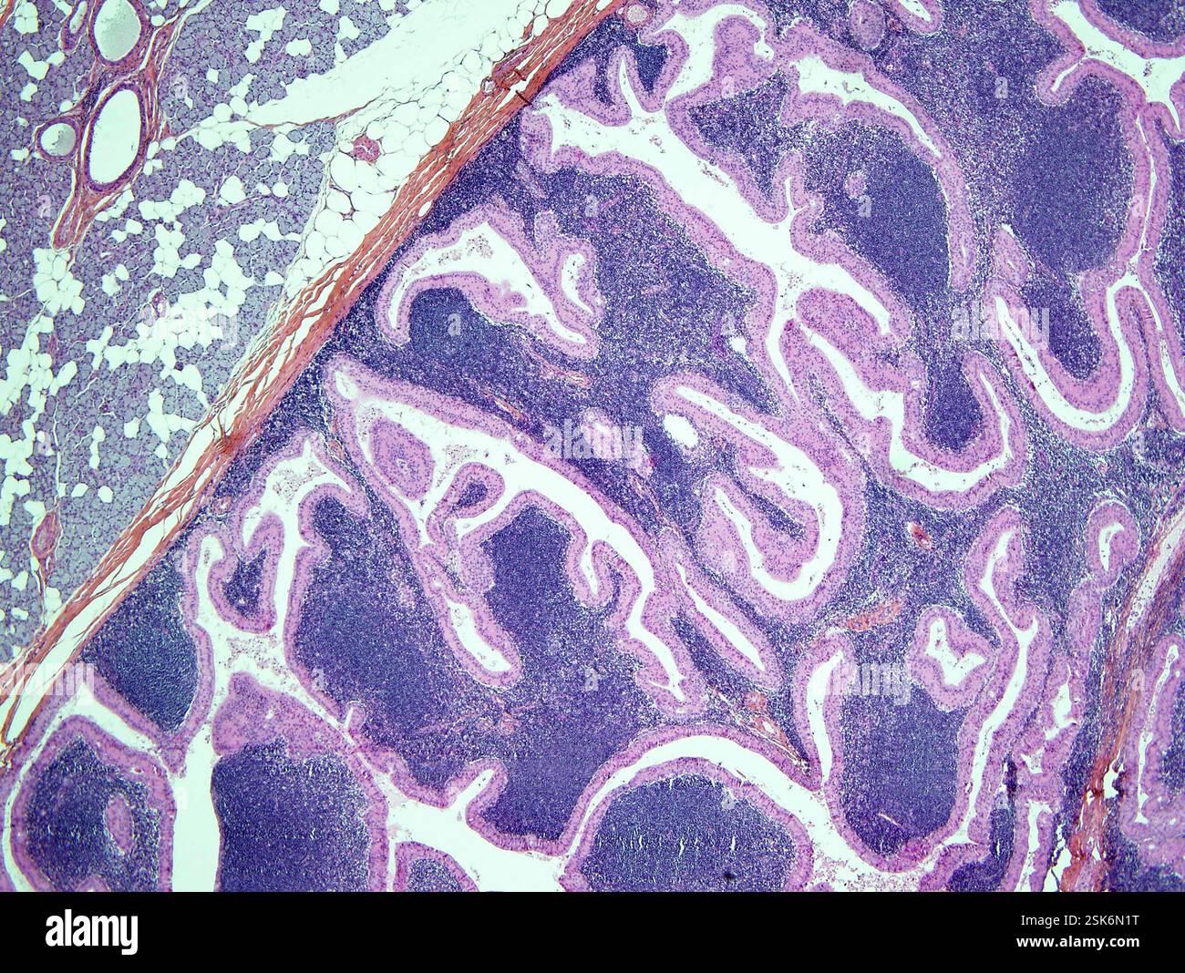 Salivary gland tumour. Light micrograph of a section through the ...