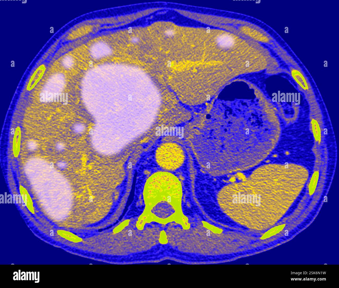 Secondary liver cancer. Coloured computed tomography scan of a section through the abdomen of a ...