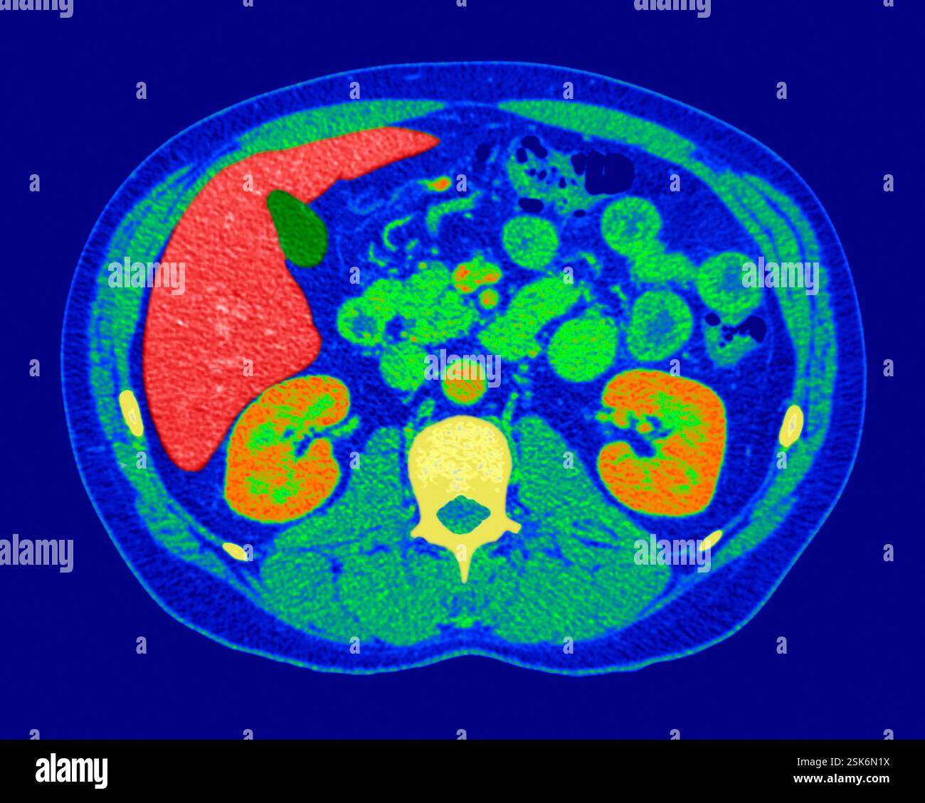 Normal abdominal organs. Coloured computed tomography (CT) scan of an axial section through a ...
