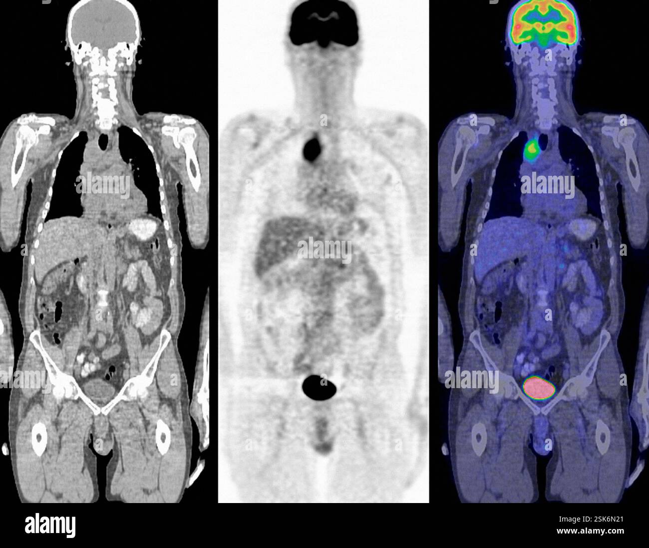 Blood cancer. Coloured computed tomography (CT) scan (left), positron emission tomography (PET ...