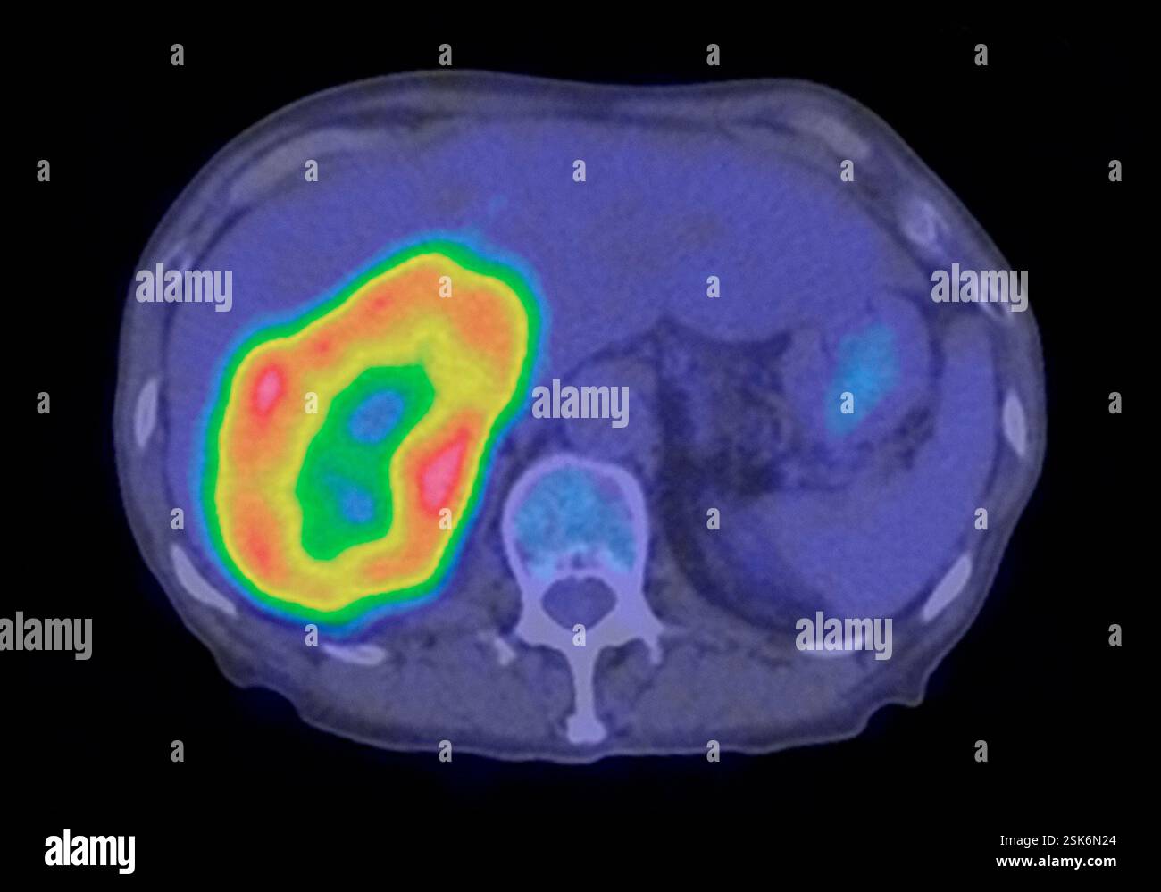 Secondary liver cancer. Combined coloured computed tomography (CT) and positron emission ...