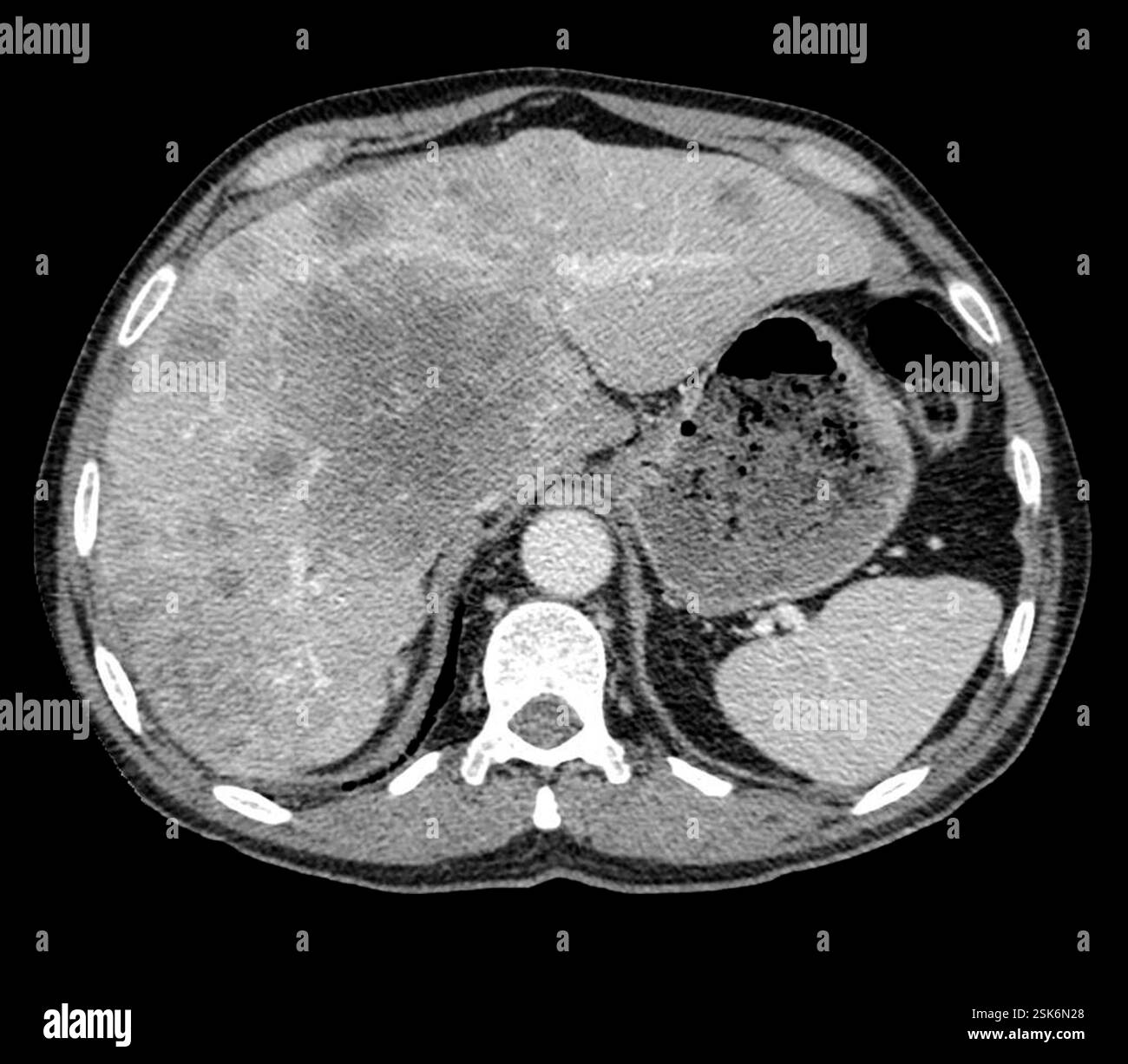 Secondary liver cancer. Computed tomography scan of a section through the abdomen of a patient ...