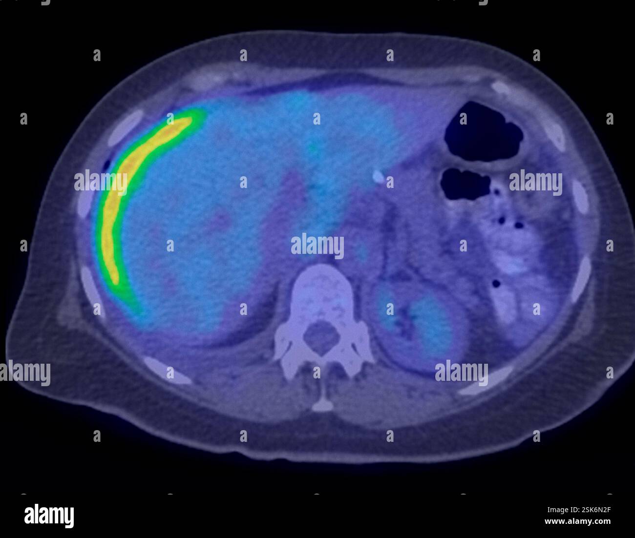 Secondary peritoneal cancer. Combined coloured computed tomography (CT) and positron emission ...