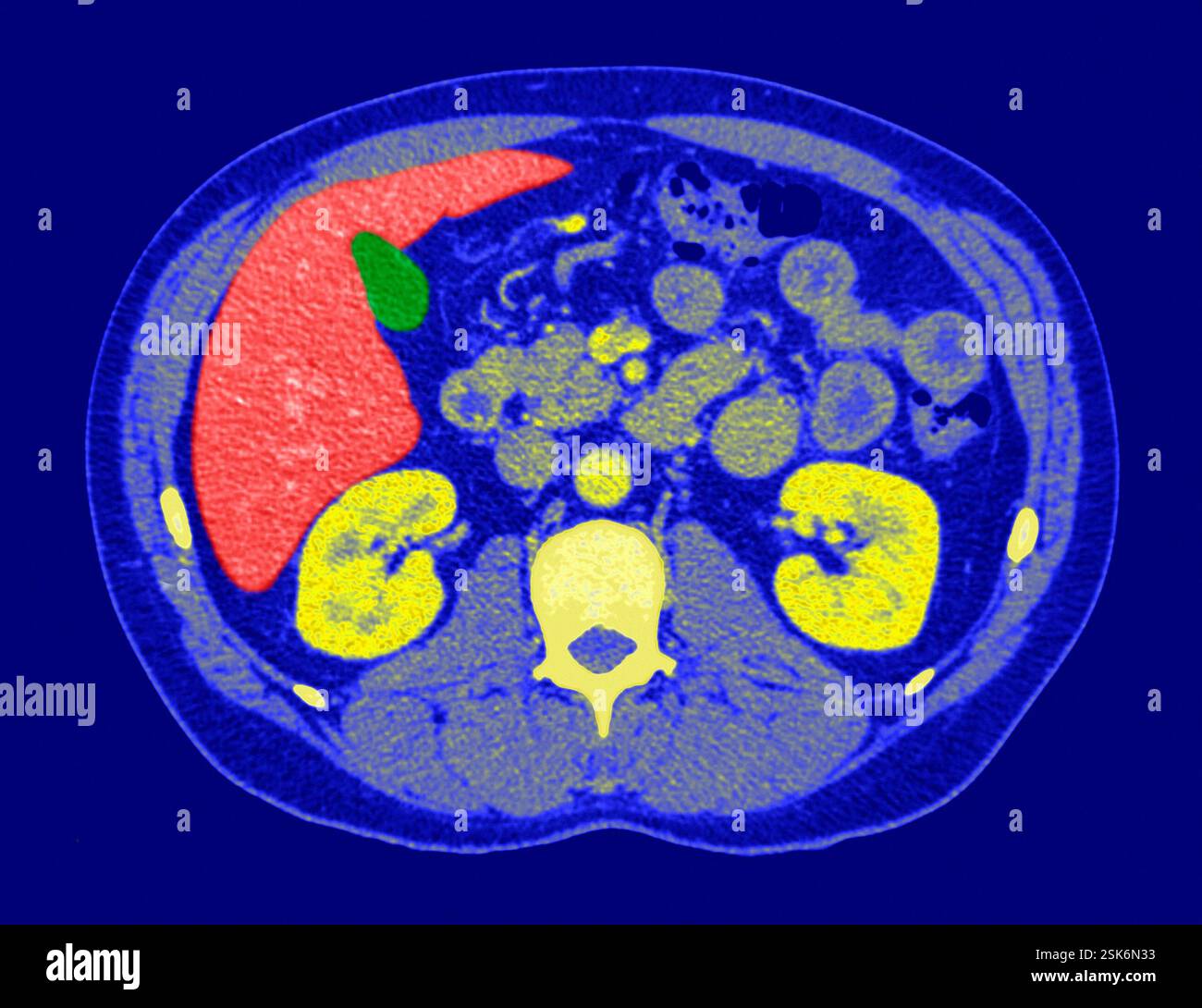 Normal abdominal organs. Coloured computed tomography (CT) scan of an ...