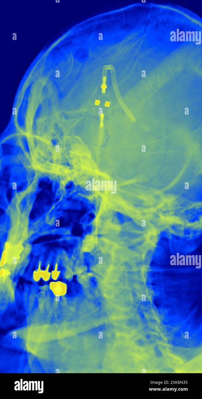 Ventricular shunt. Coloured X-ray showing a ventricular shunt (upper ...
