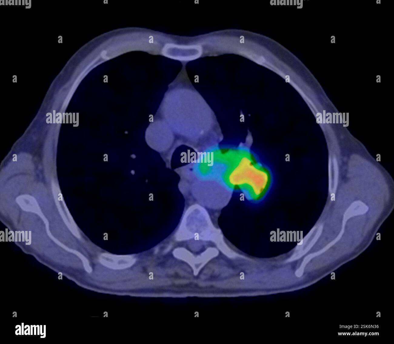Lung cancer. Combined coloured computed tomography (CT) and positron emission tomography (PET ...