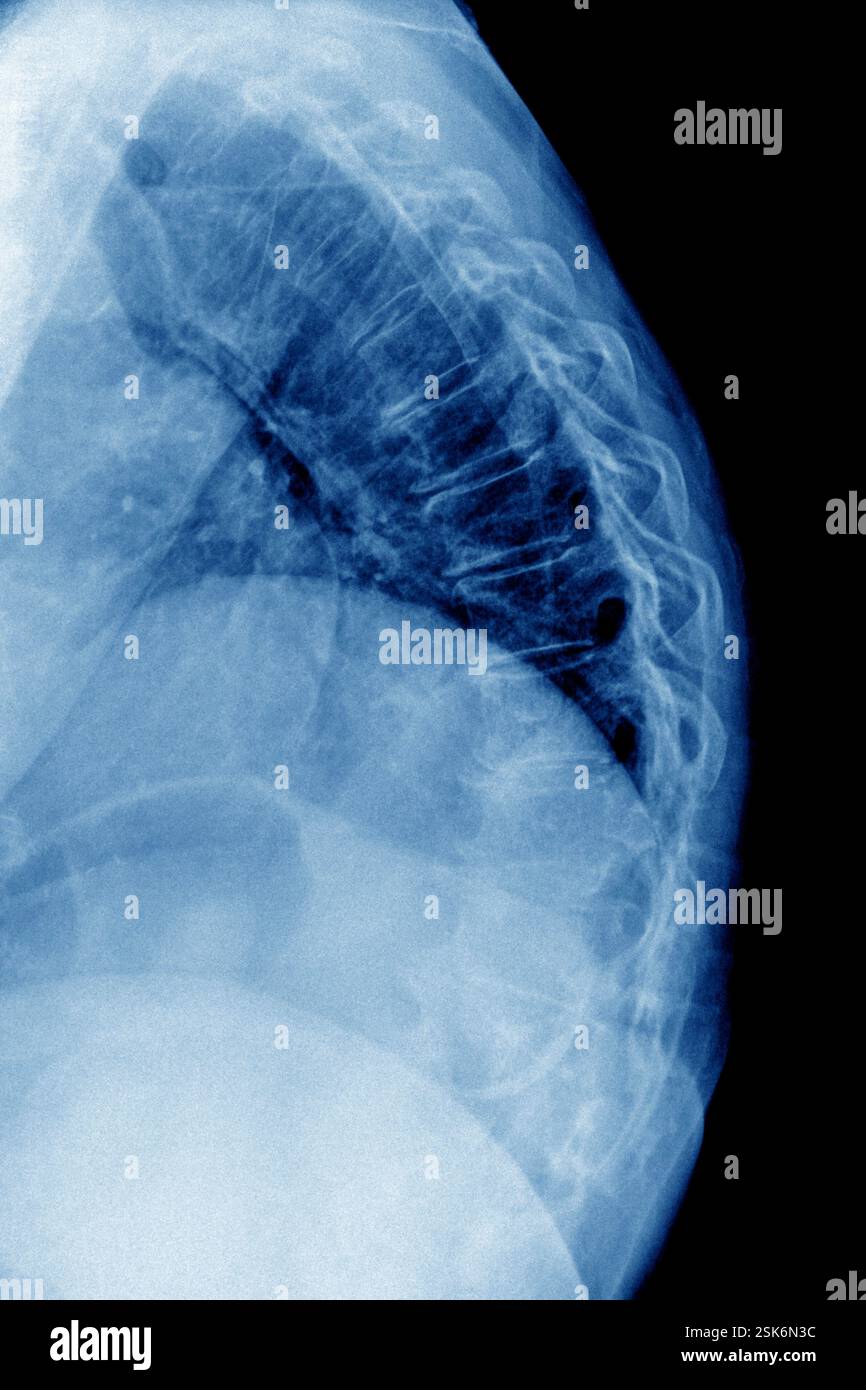 Curved spine. Coloured X-ray of a patient with kyphosis (curvature of ...